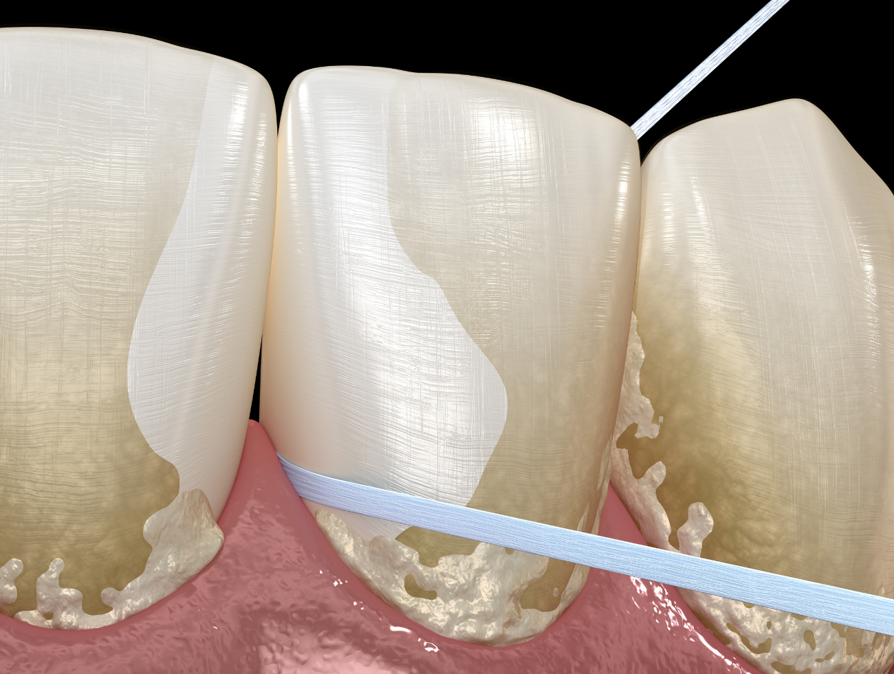 Flossing: The Unsung Hero of Oral Health Kiwi Dental - Dentist Oakville ...
